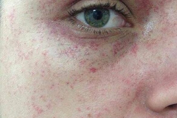 Petequias archivos - Salud Diez