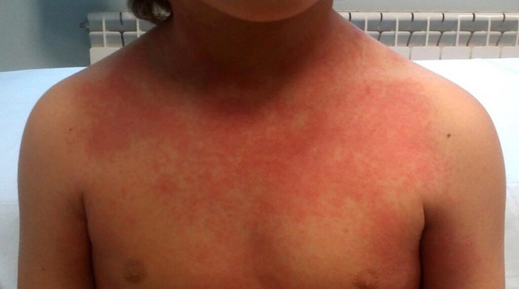 Petequias: esas manchitas rojas en la piel - Salud Diez