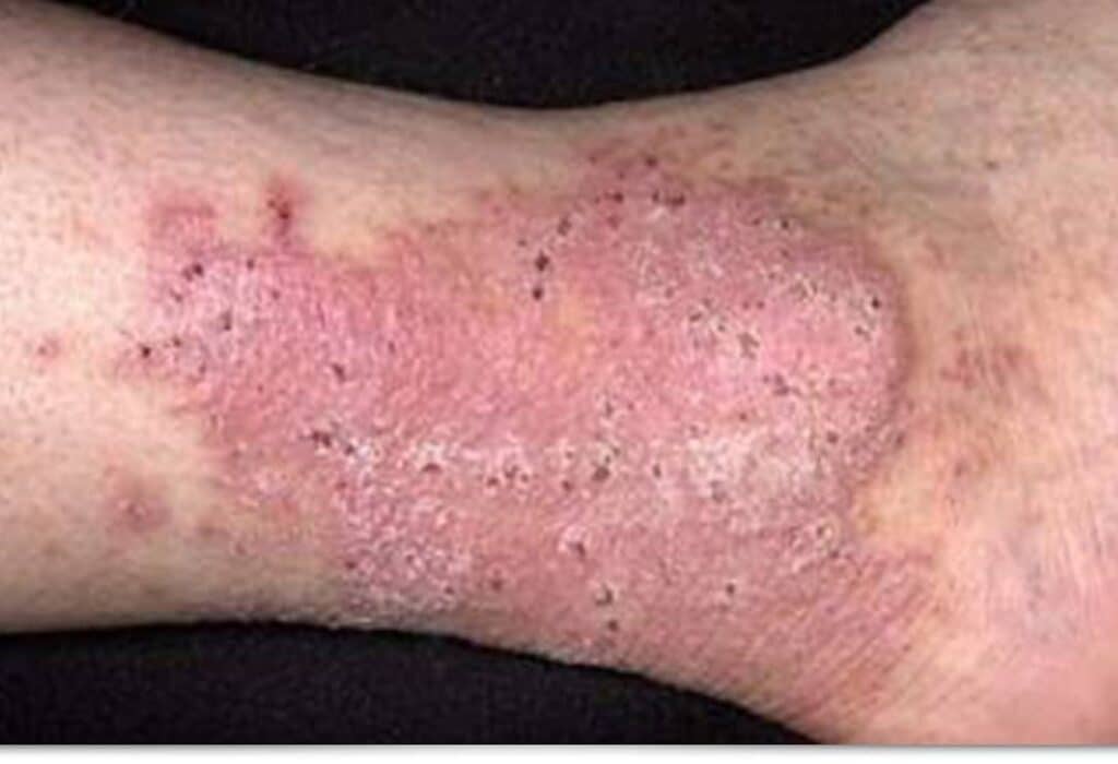 Xerosis: lo que llamamos sequedad de la piel. - Salud Diez