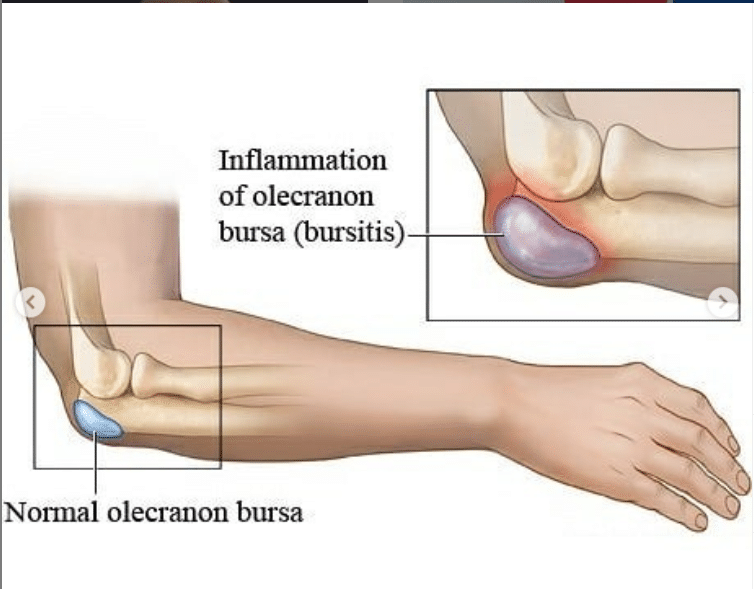 Bursitis: Todo lo que debes saber sobre esta enfermedad - Salud Diez
