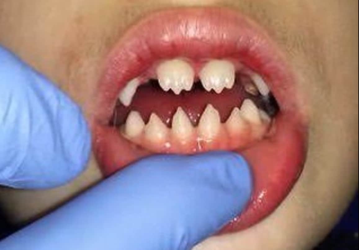 Sífilis y sus síntomas: ¿Cuáles son y cómo tratarla? - Salud Diez