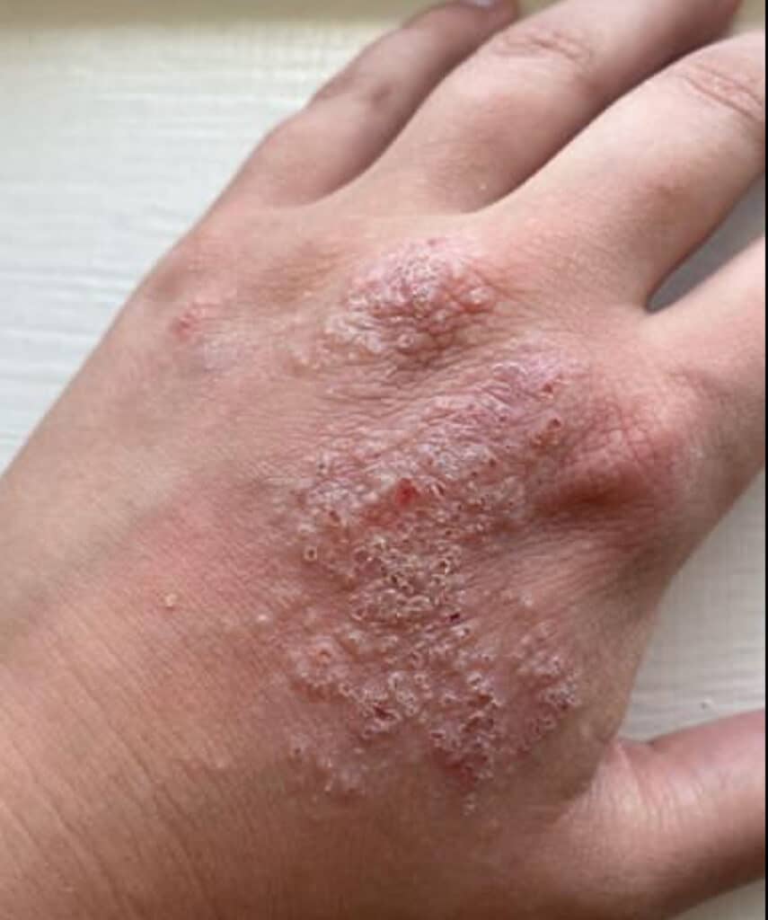 Eccema numular ¿cómo afecta la salud de nuestra piel? - Salud Diez